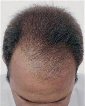 Telogen effluvium hairline store
