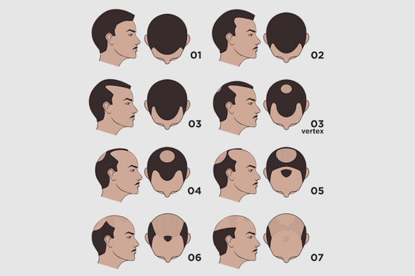 Male Pattern Hair Loss - HairMax